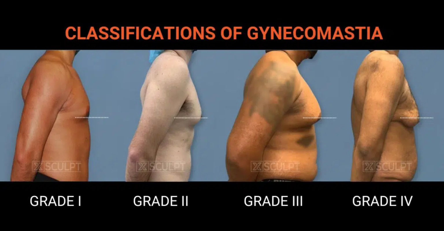 Is Gynecomastia Surgery Right For You? | XSculpt™